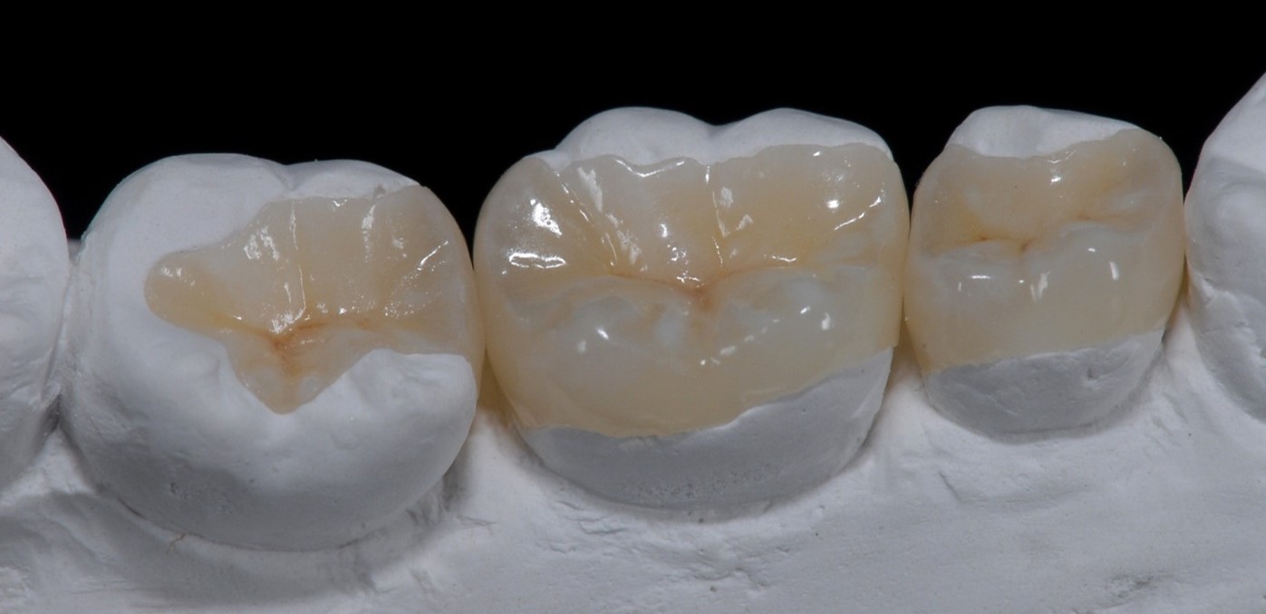 Restorative Dentistry – Munich